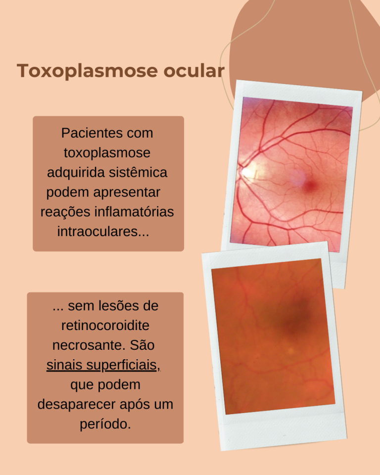 Toxoplasmose Ocular - Sinais Superficiais | Clínica Silveira